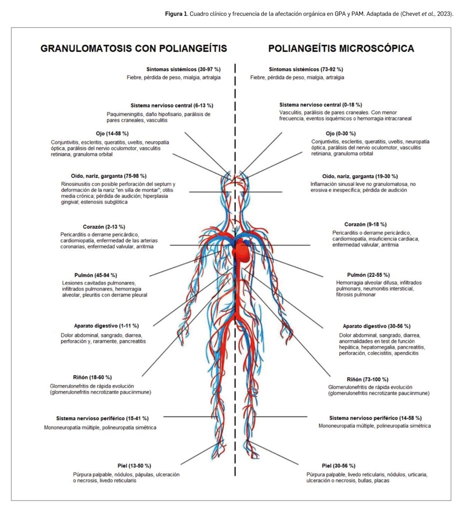 Avacopán en granulomatosis con poliangeítis y poliangeítis microscópica ...
